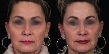 Dilute Radiesse® Before And After Pictures - Derma Skin Institute